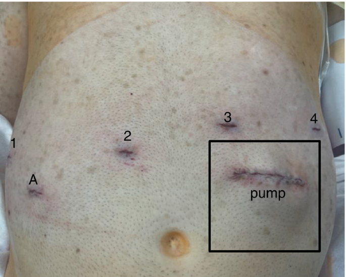 Robotic Approach to Hepatic Arterial Infusion Pump Placement | SpringerLink