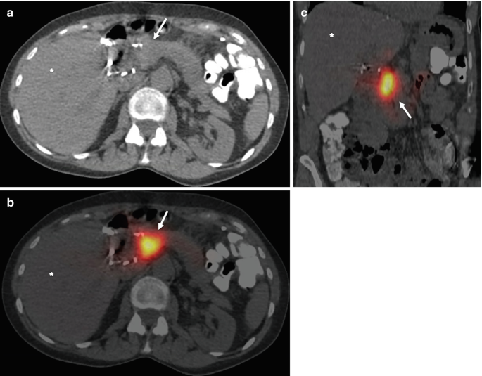 Hepatic Arterial Infusion Pumps for Malignancy From a Molecular Imaging ...