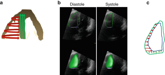 Right Ventricular Failure in Patients with Durable Mechanical ...