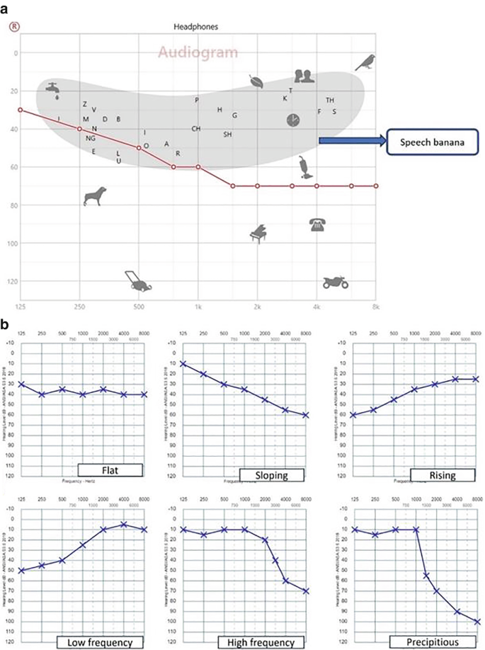 Behavioral and Electrophysiological Tests in Audiology | SpringerLink