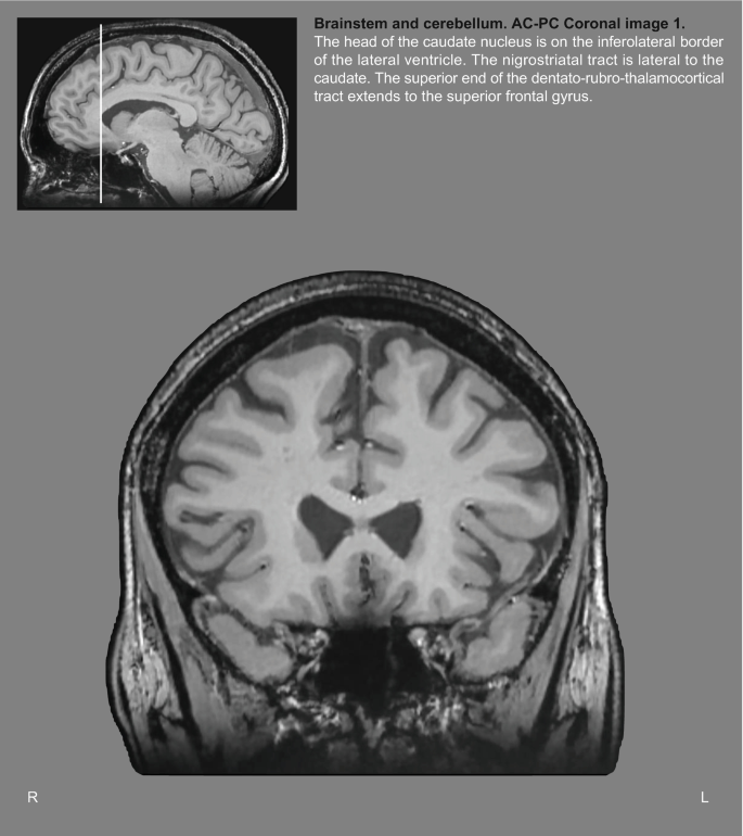Coronal Slices of the Brainstem and Cerebellum: AC-PC Orientation ...