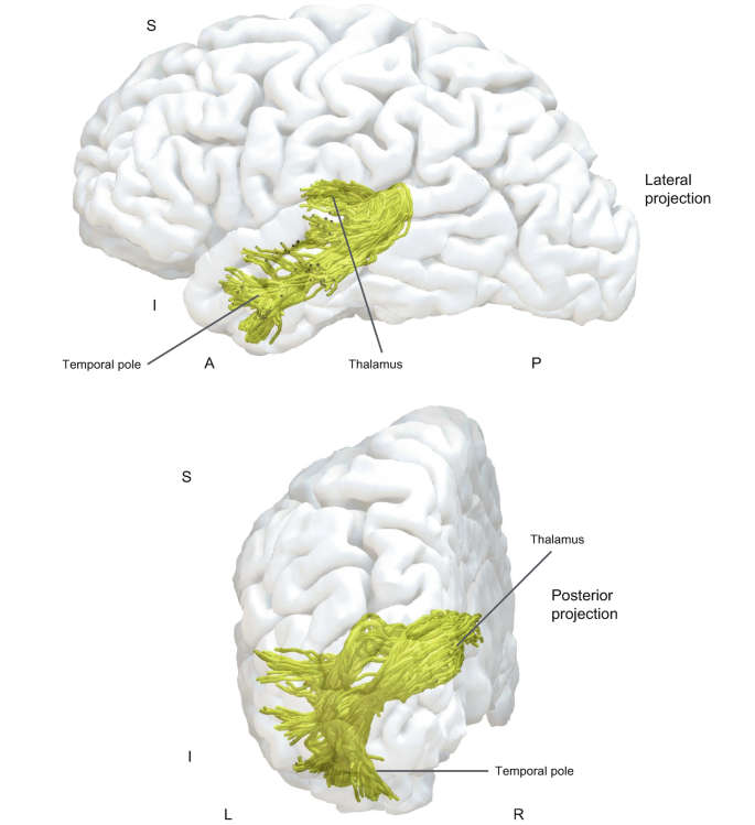 Inferior Thalamic Radiation | Springer Nature Link
