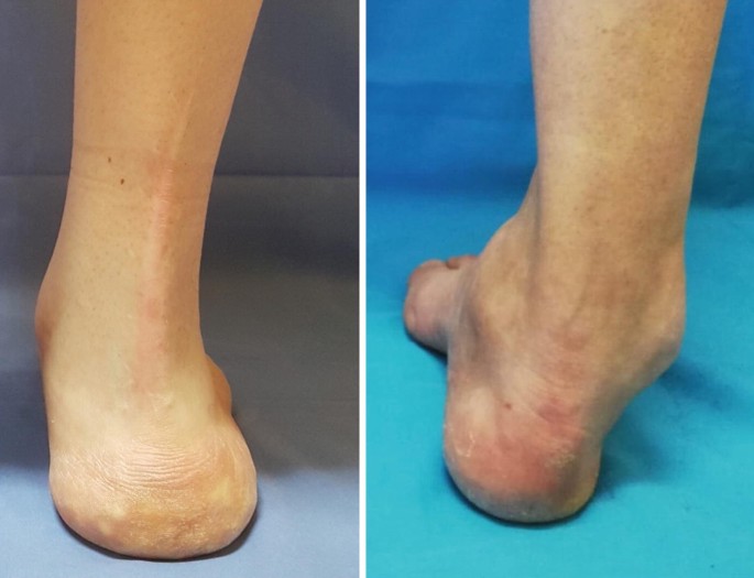 Patient Positioning and Planning in Total Ankle Replacement Through ...