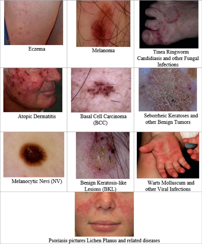 Deep Learning Strategies for Multiclass Skin Disease Classification ...