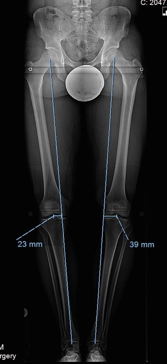 Correction of Bilateral Genu Varum for a High Level Athlete | SpringerLink