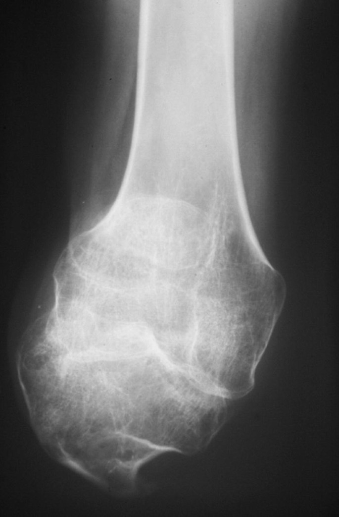 An Initially Successful Lengthening of a Traumatic Below Knee ...