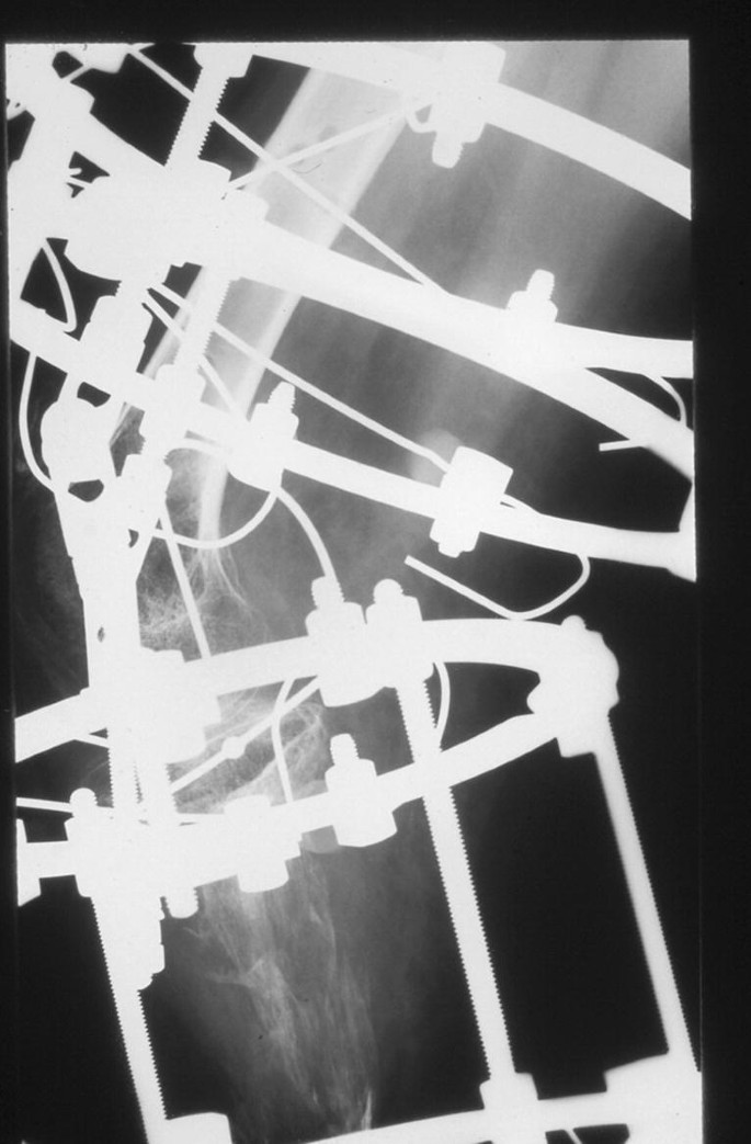 An Initially Successful Lengthening of a Traumatic Below Knee ...