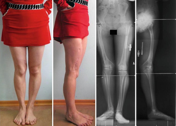 Correction of Valgus-Torsion Deformity of the Femur and Varustorsion ...
