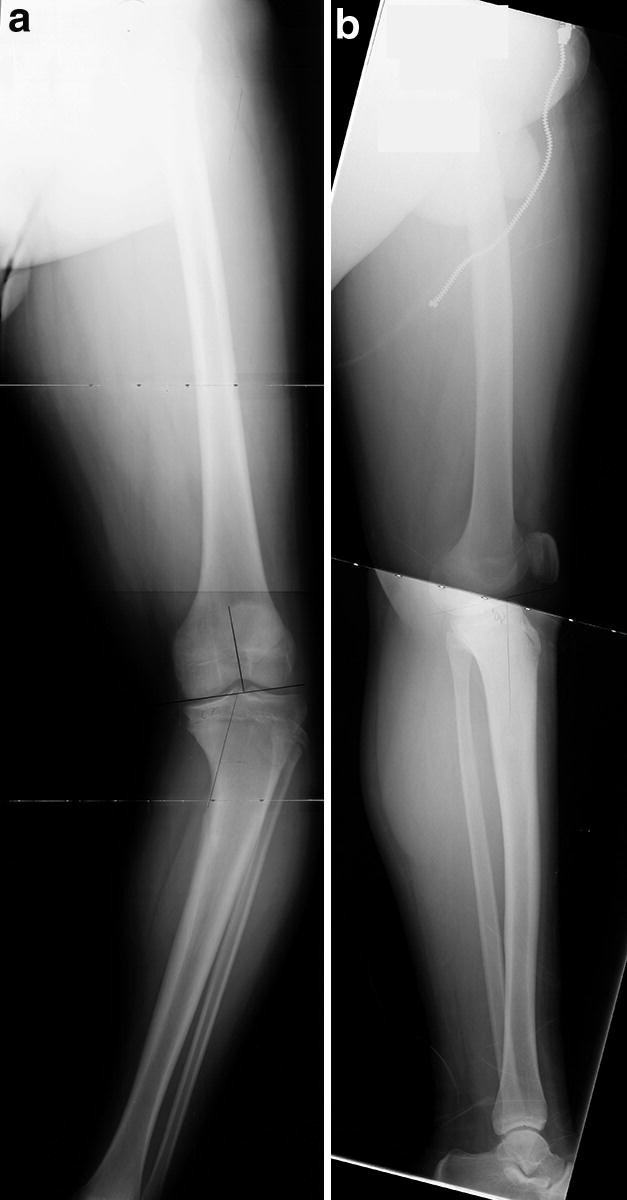 Femoral and Tibial Rotational Deformity Treated with Fixator Assisted ...