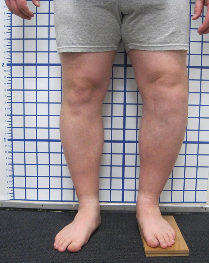 Correction of Varus Deformity of the Femur and Tibia in Patient with ...