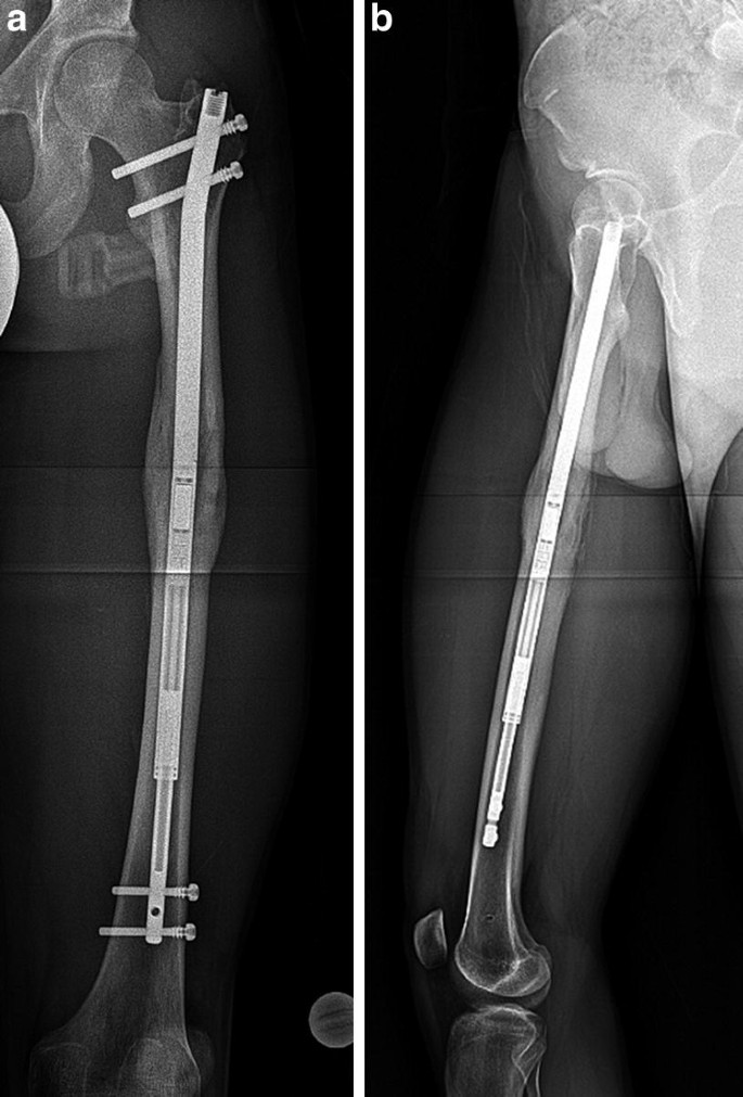 Femur Lengthening with Precice Internal Lengthening Nail | SpringerLink