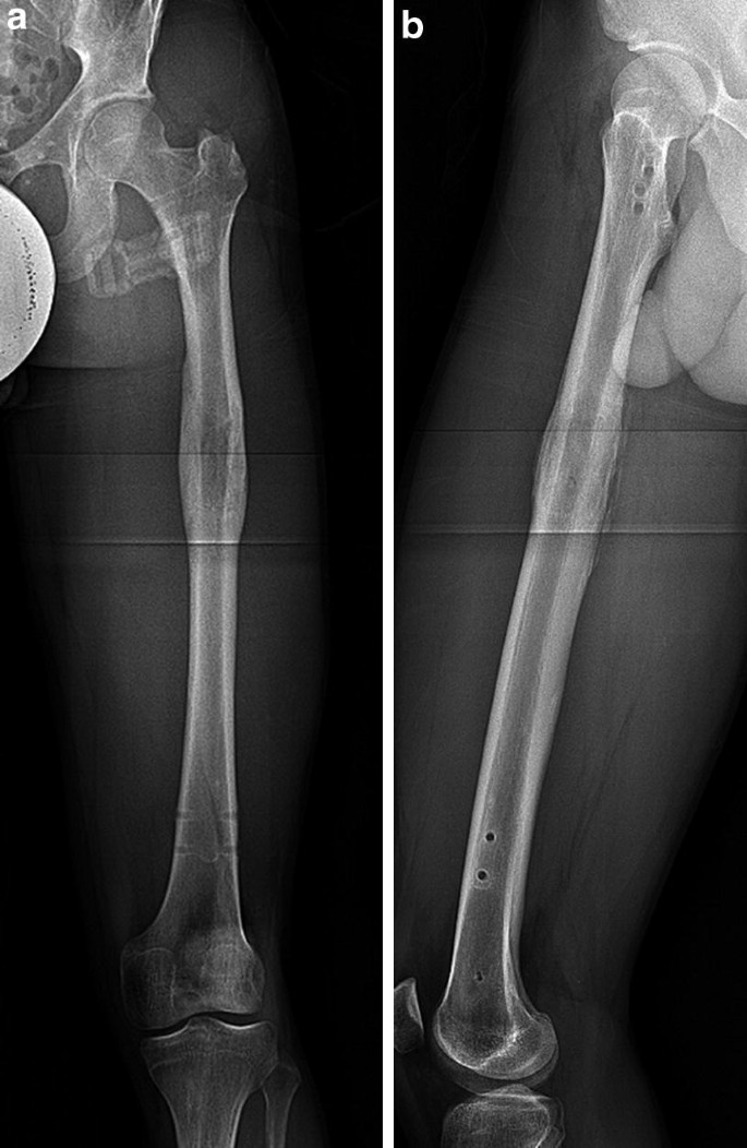 Femur Lengthening with Precice Internal Lengthening Nail | SpringerLink
