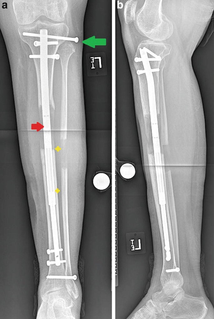Tibia Lengthening with Precice Internal Lengthening Nail | SpringerLink