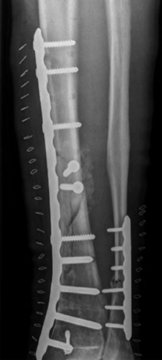 Motorized Intramedullary Transport and Lengthening Nail Used to ...