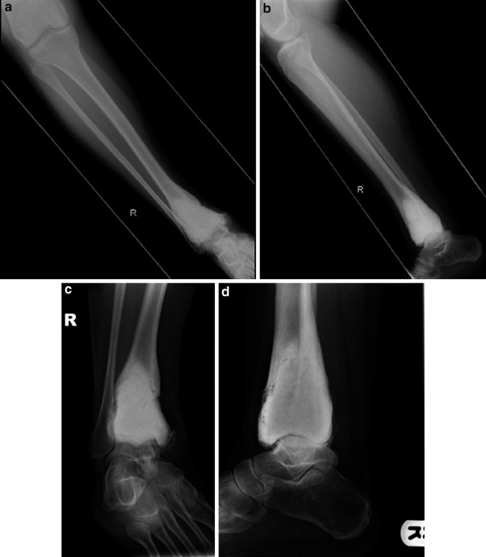 Tibio-Talar Fusion to Treat Bone Defect and Ankle Arthritis Following ...