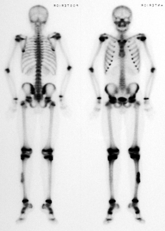 Reconstruction of a Bone Defect (Malignant Bone Tumor) in the ...