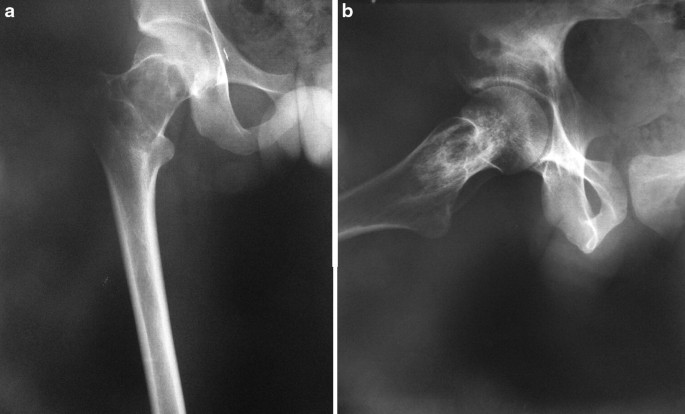 Femoral Neck Aneurysmal Bone Cyst Treated with Articulated Distraction ...