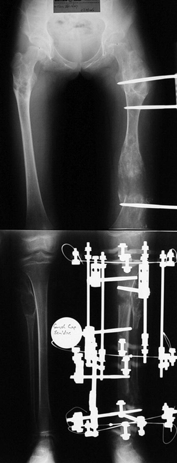 Correction of Long Bone Deformities due to Ollier’s Disease with ...