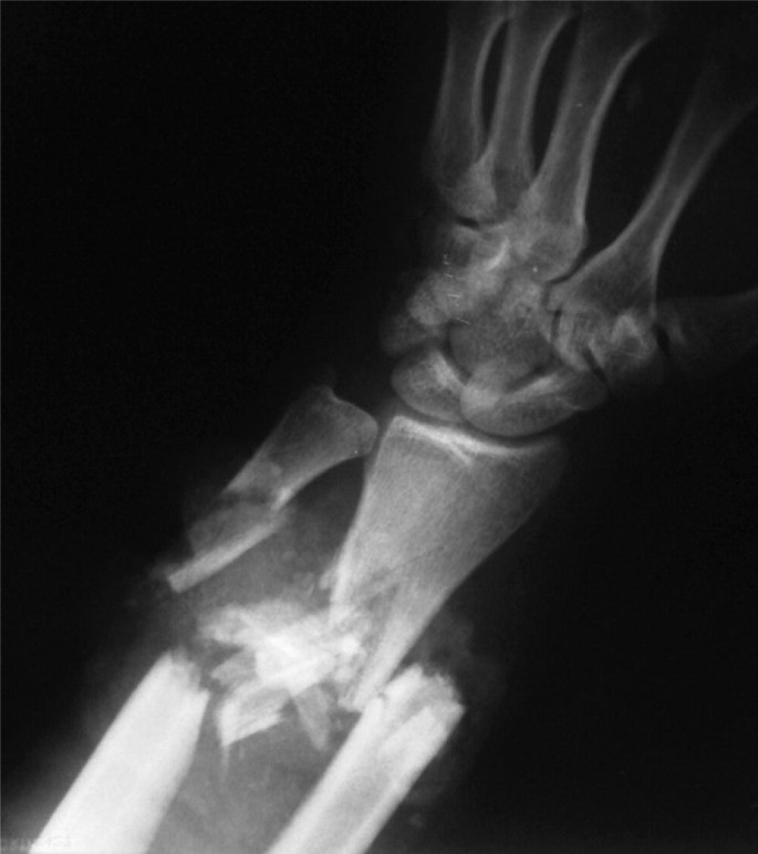 Reconstruction of the Elbow After Gunshot Injury with Dynamic ...