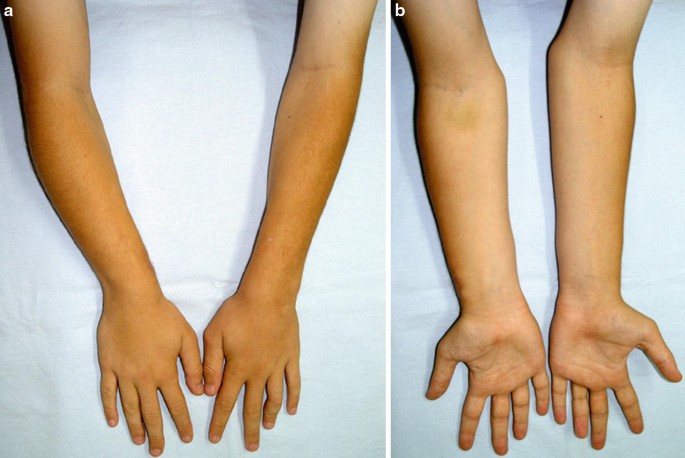 Correction of Forearm by Corrective Radial Osteotomy and Ulnar ...