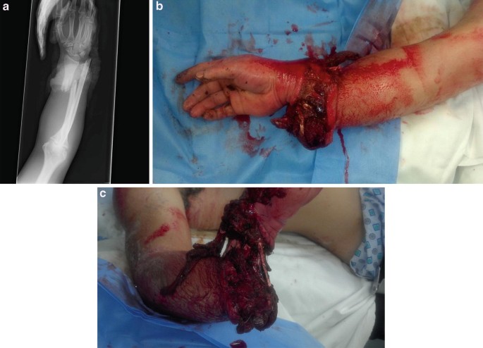 Mangled Upper Extremity Salvaged with Spatial Frame, Skin Grafts ...