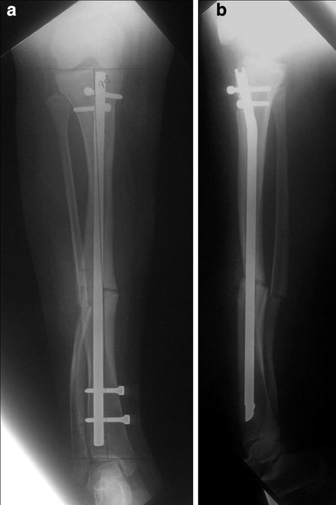 Complex Tibial Deformity: Acute Correction and IM Nail Fixation ...