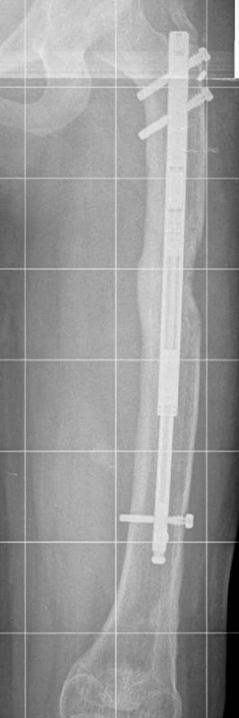 Partial Union After Lengthening: A New Concept in Bone Healing ...