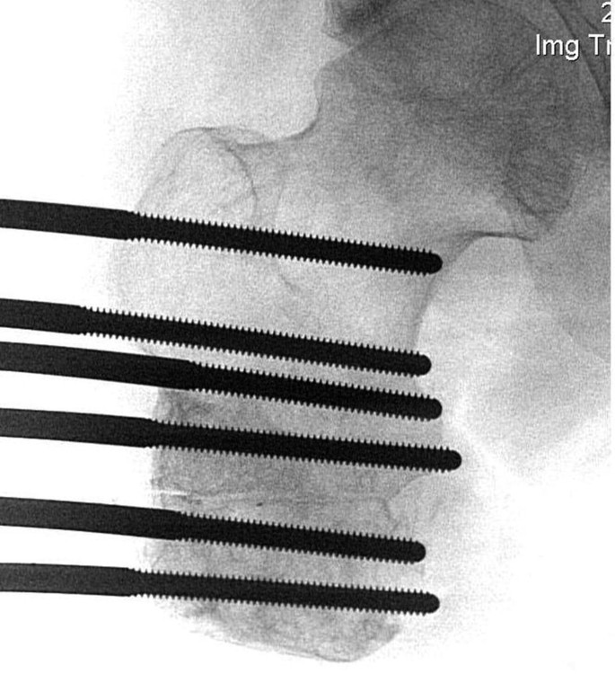 Post-traumatic Short Femoral Stump Lengthened with a Monolateral ...