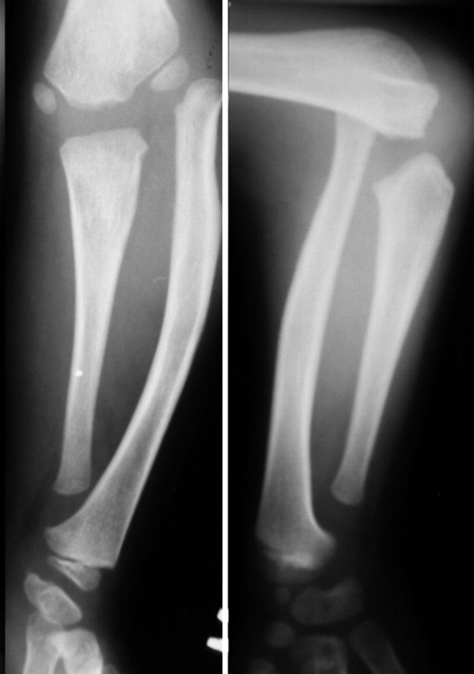 Congenital Malformation of the Upper Limb (Ulnar Clubhand) in a 6 Year ...