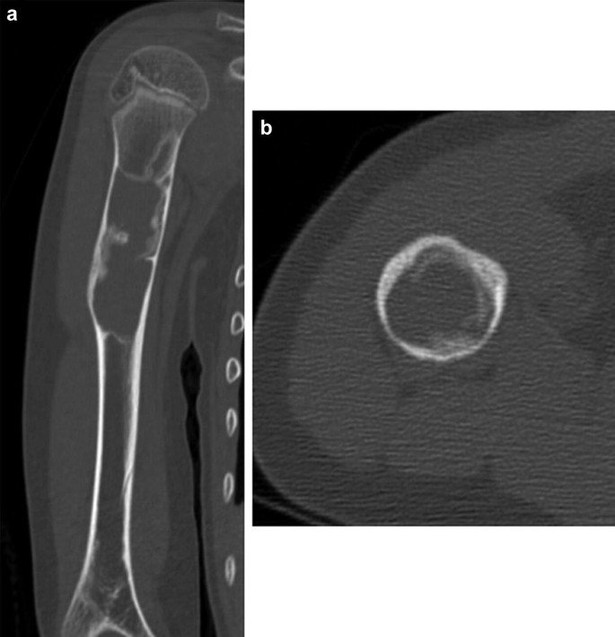Benign Tumor 1: Decompression and Cannulation for Simple Bone Cyst | SpringerLink