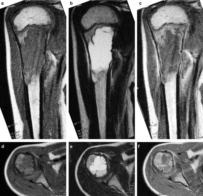 Benign Tumor 1: Decompression and Cannulation for Simple Bone Cyst | SpringerLink