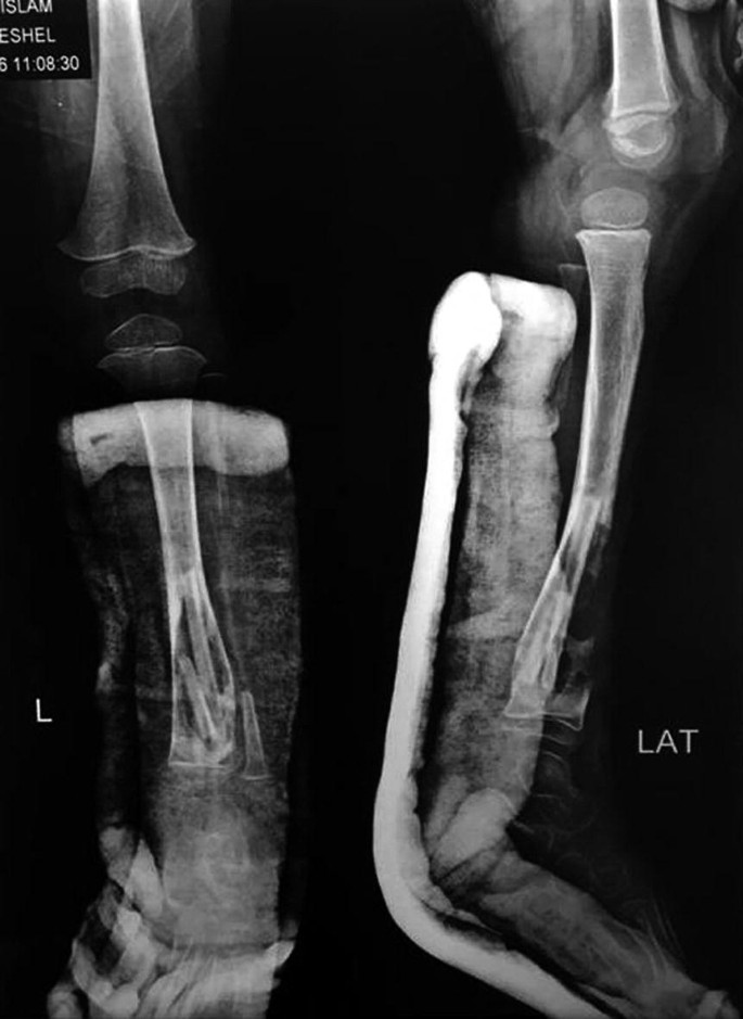 Management of Deformities After Treatment of Simple Bone Cyst | SpringerLink