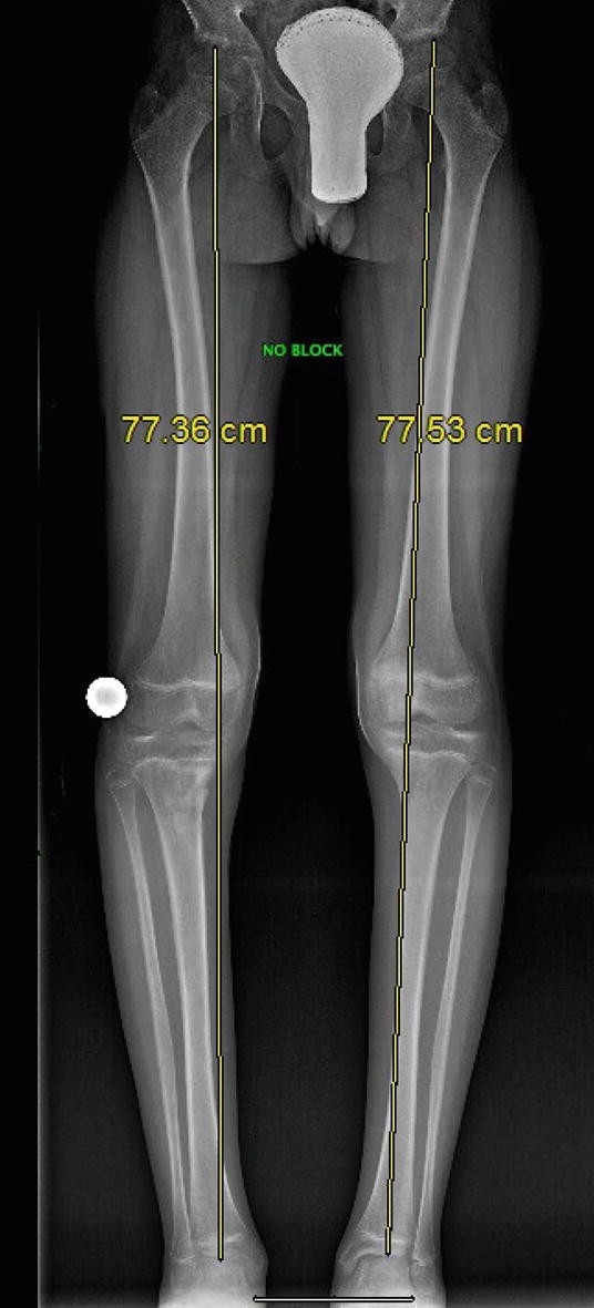 Joint Preserving Peri-articular Reconstruction of Proximal Tibia After ...