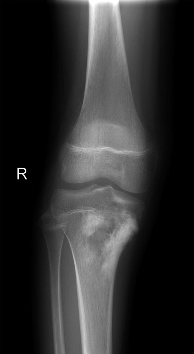 Malignant Tumor 1: Frozen Autograft-Prosthesis Composite for Proximal ...