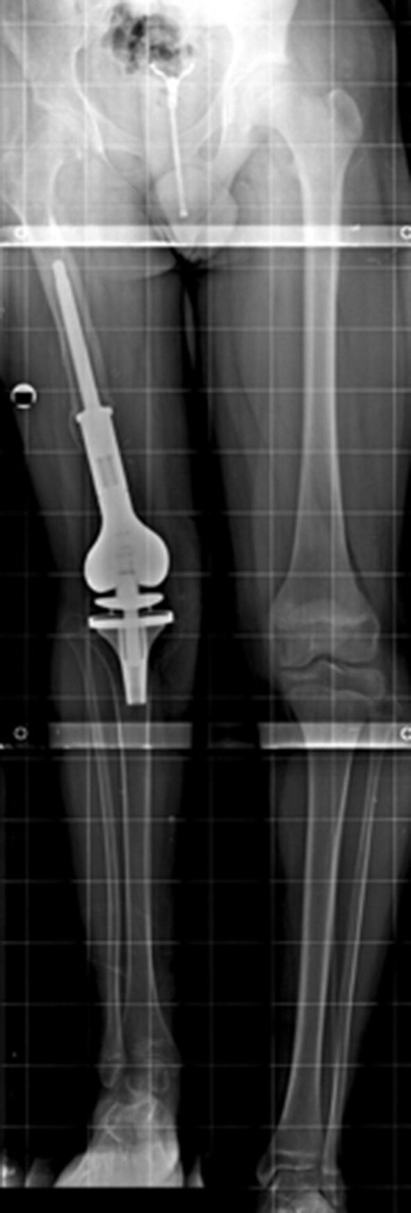 Distal Femur Prosthetic Revision Aided by Soft Tissue Distraction and ...