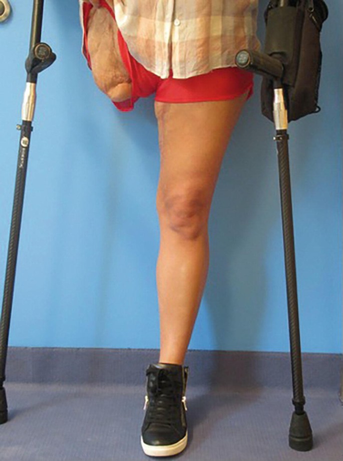 Osseointegration Amputation Reconstruction Extremely Short Femur | SpringerLink