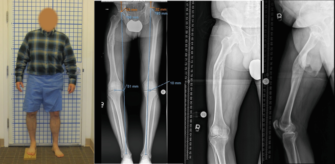 Lengthening and Correction of Femur Malunion Followed by High Tibial ...