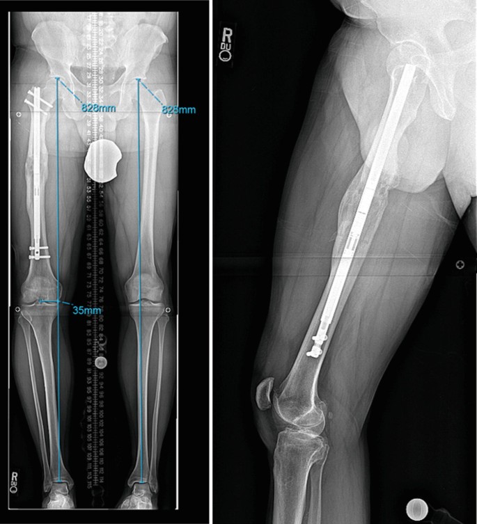 Lengthening and Correction of Femur Malunion Followed by High Tibial Osteotomy | SpringerLink