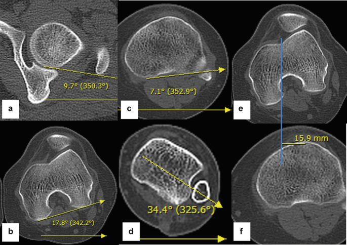 Leg Length Discrepancy Combined with Multiplane Deformities and ...