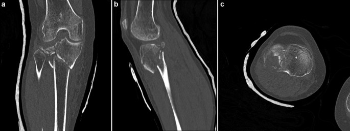 Minimally Invasive (2 cm Incision) Tibial Plateau Elevation and ...