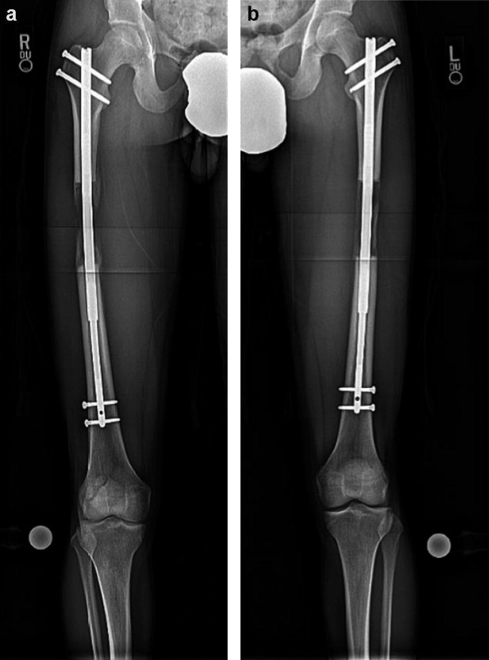 Bilateral Femur Stature Lengthening with Precice Stryde Nails | SpringerLink