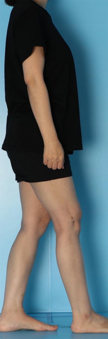 Acute Correction of Multiplane Deformity and Bone Defect as a Result of ...