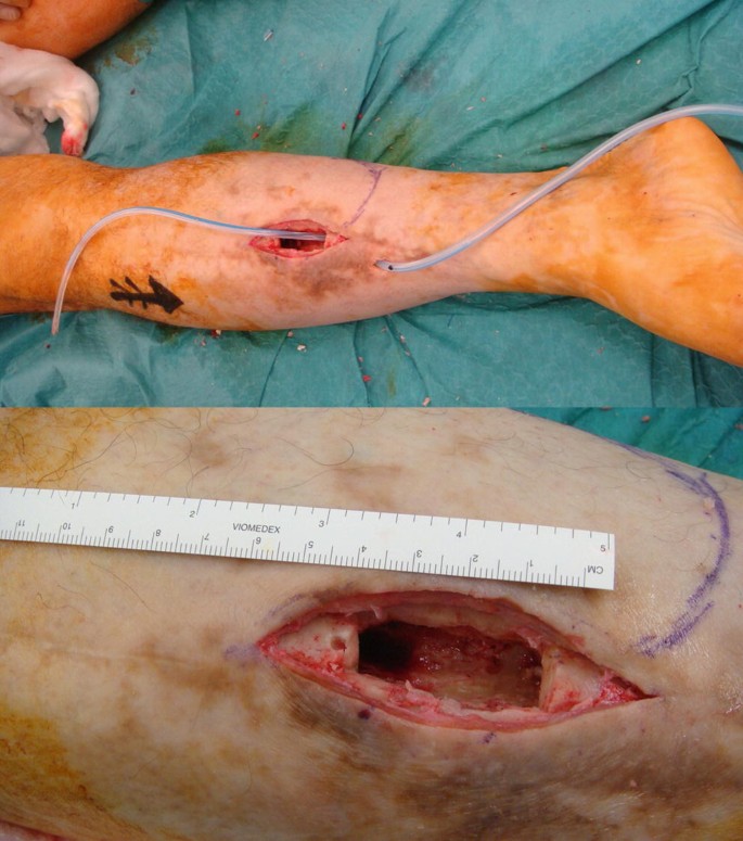 Biological Dead Space Management of Osteomyelitis: Debridement and ...