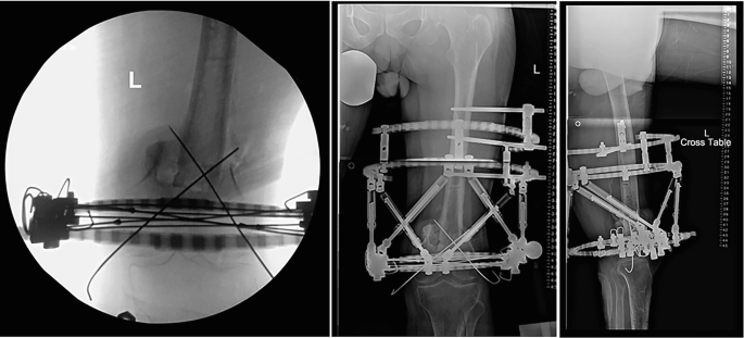 Infected Distal Femur Nonunion Treated with a Circular External Fixator Then Internal ...