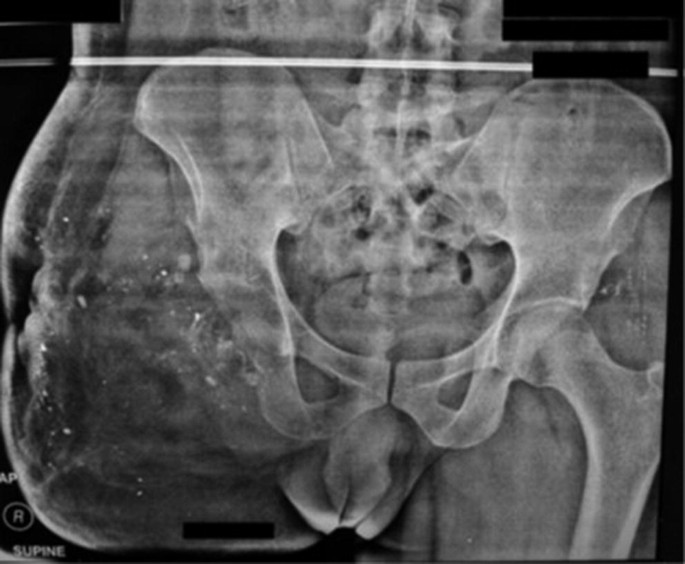 Press-Fit Osseointegration for the Pelvic Disarticulation Amputee ...