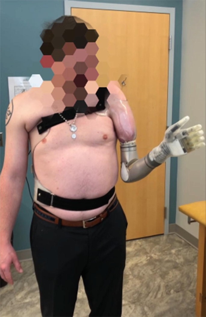 Press-Fit Osseointegration for the Transhumeral Amputee | SpringerLink