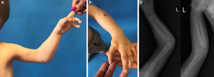 Use of a Hexapod Frame for Correction of Congenital Elbow Flexion ...