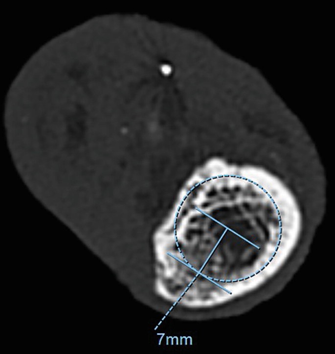 Reconstruction of Transulnar Amputation with Osseointegration ...