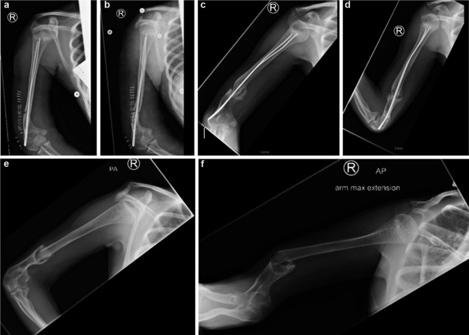 Distal Humeral Shaft Fracture in Osteogenesis Imperfecta Patient Fixed Initially with Elastic ...