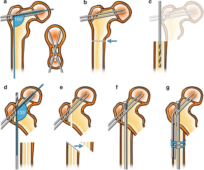 Coxa Vara in a Nine-Year-Old Boy with Osteogenesis Imperfecta ...